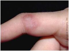 Herpes Simplex Virus - IAFF